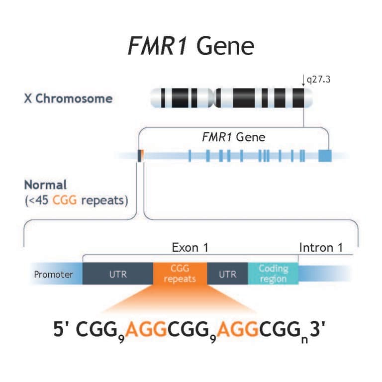 Fragile X Syndrome | Resources for Prospective Parents | Asuragen